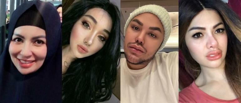 10 Artis yang Jalani Prosedur Lip Filler, Lebih Pede dengan Bibir Tebal ...